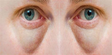 علاج الانتفاخ تحت العينين في أقل من ساعة Android App