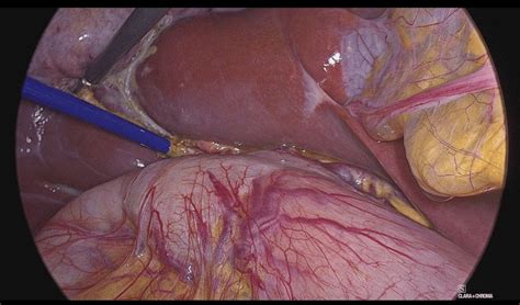 Laparoscopic Transcystic Spyglass Discover Assisted Common Bile Duct