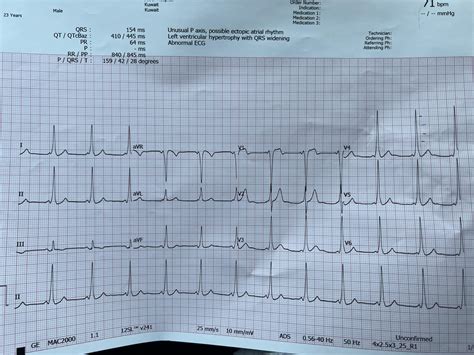 Ectopic Atrial Tachycardia Ecg