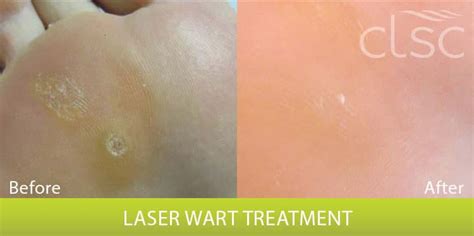 Laser Wart Treatment Before And After Columbia Laser Skin Center