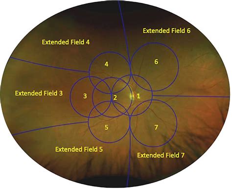Peripheral Lesions Take Dr Imaging Beyond Etdrs