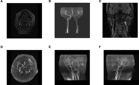 Preoperative Head And Neck Magnetic Resonance Angiography Mra