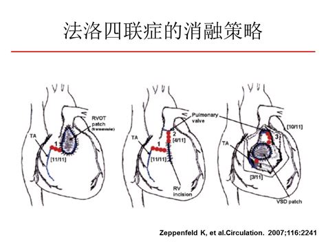 参赛病例15 陈红武：法洛四联症外科修补术后室速的射频消融一例 严道医声网