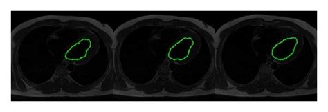 Mr Images Left Ventricle Segmentation A Manual Delineation By Download Scientific Diagram