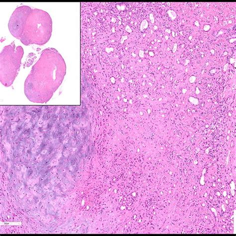 Pa A Clinical View Of A Submucosal Nodule In The Left Buccal Mucosa Download Scientific