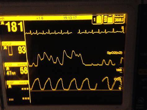 Use Capnography As A Primary Assessment Tool For Asthma And 54 Off