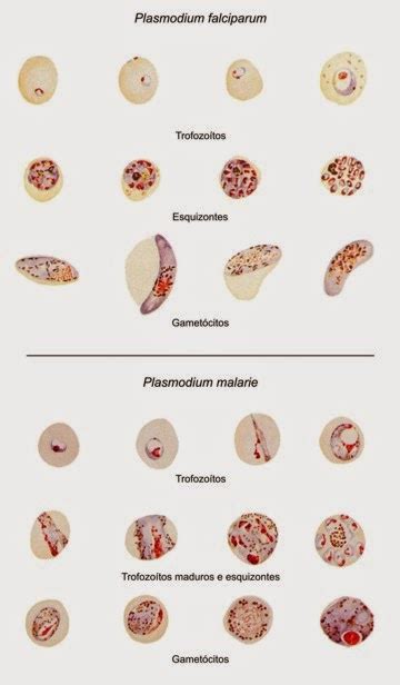 Fichero De HematologÍa Anormalidades Eritrocitarias Anormalidades De