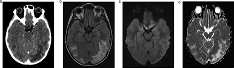 Brain Ct Scan A Showing Areas Of Ill Defined Hypoattenuation