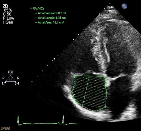 Right Atrial Strain In A Normal Adult African Population And Its