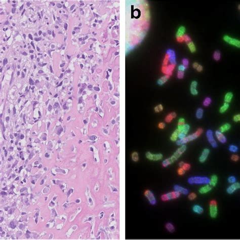 High Grade Osteosarcoma A Conventional Osteoblastic Osteosarcoma Download Scientific Diagram