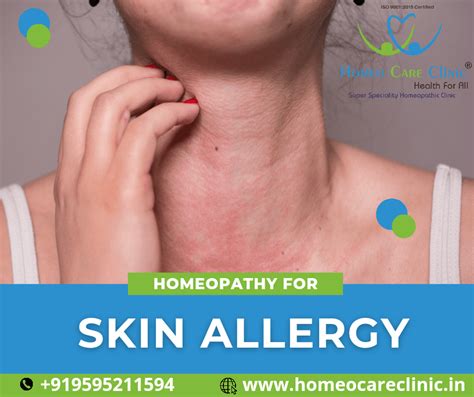 Homeopathic Treatment For Skin Diseases Homoeopathic Medicine