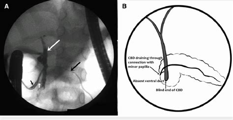 A Cholangiogram Image Showing Absent Ventral Duct Bile Duct Large Download Scientific