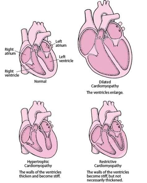 Image Types Of Cardiomyopathy Msd Manual Consumer Version