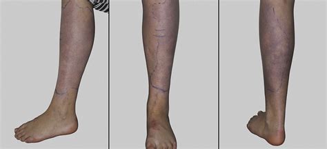 Acrodermatitis Chronica Atrophicans The Journal Of Pediatrics