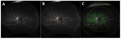 Quantitative Imaging Biomarkers In Age Related Macular Degeneration And Diabetic Eye Disease A
