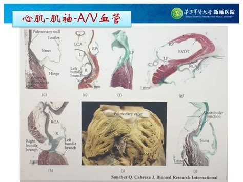 参赛病例21 宋元彬特殊电位指导消融流出道室早1例 严道脑血管网