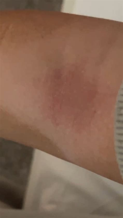 Sjogrens Flare Rash Rsjogrens