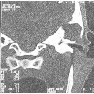 Normal CT Temporal Bone Coronal Cut Download Scientific Diagram