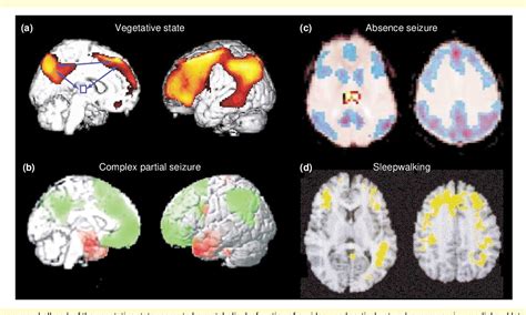Figure 2 From The Neural Correlate Of Un Awareness Lessons From The Vegetative State