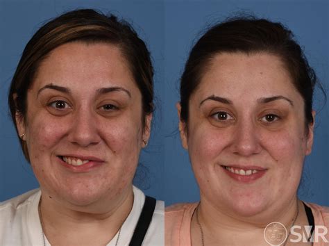 Blepharospasm Botox Before And After