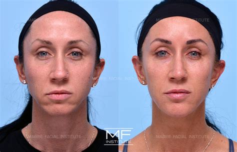 Marionette Lines And Jowling Before And After Pictures Case 921 San