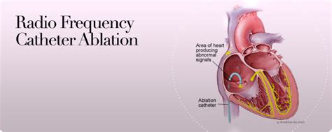 Radiofrequency Catheter Ablation Ruth Kam Heart And Arrhythmia Clinic