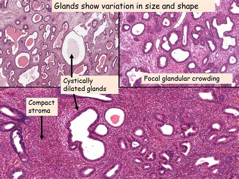 Pathology Outlines Endometriosis