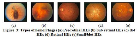 An Automatic Detection Of Hemorrhages In Retinal Fundus Images By Motion Pattern Generation