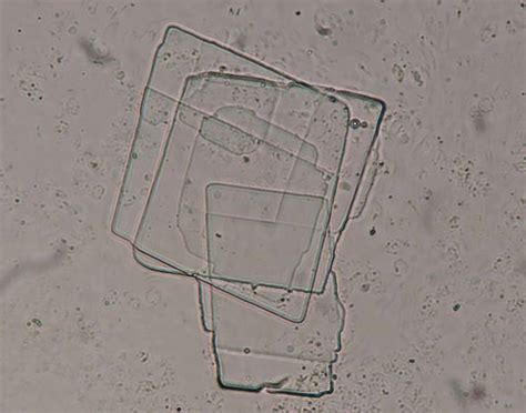 Labclinico Dg Colesterol🔬 Los Cristales De Colesterol