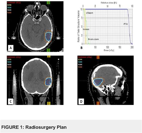Figure 1 From Scalp Seeding Post Craniotomy And Radiosurgery For