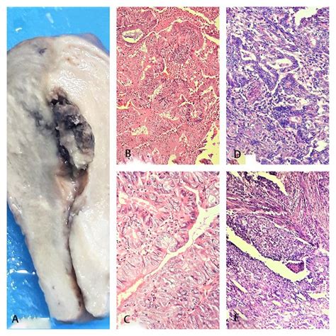 A C Gross Picture And Photomicrographs Of Angiomyolipoma Of Cervix