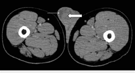 Post Contrast Axial Ct Section At The Level Of Testis Showing Download Scientific Diagram