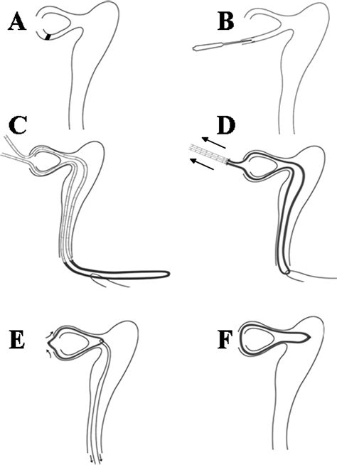 A Novel Procedure For Treating Canalicular Obstruction By Re