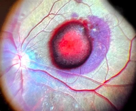 Blog Ruptured Retinal Artery Macroaneurysm Prime Retina Eye Care Centre Best Eye Hospital In