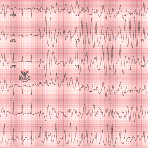 Afib Ecg Weekly