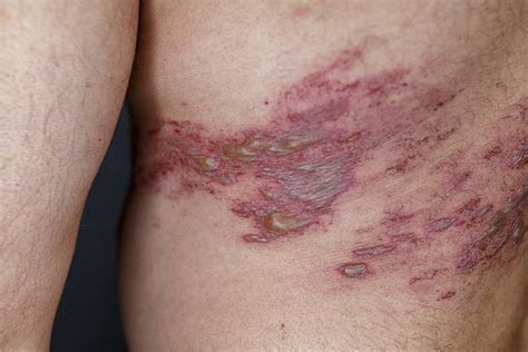 34 Facts About Varicella