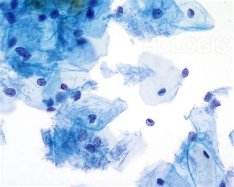 Pathology Outlines Lactobacillus