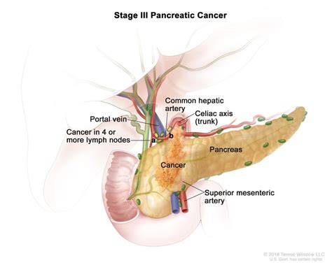 Pancreatic Cancer Treatment Pdq® Nci