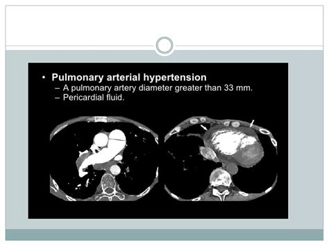 Pulmonary Embolism Radiology Pptx