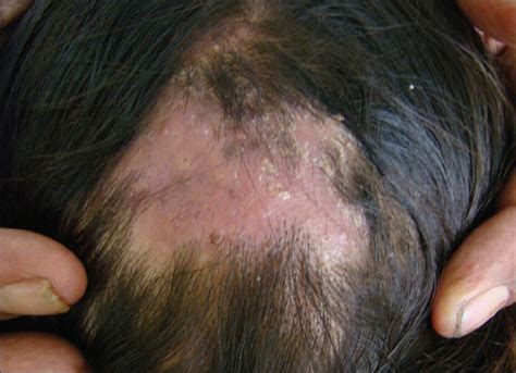 Human Demodex Mite The Versatile Mite Of Dermatological Importance Pmc