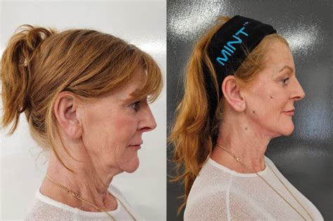 Before And After Images Of Aesthetic Treatments By Dr Matla Newcastle