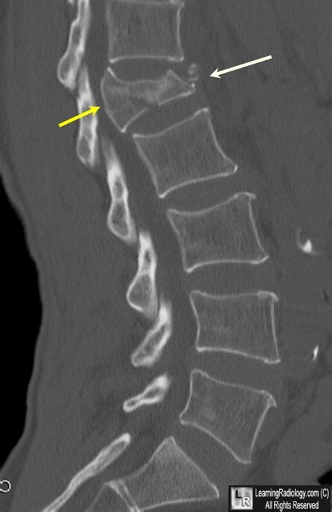 Burst Fracture Of Lumbar Spine Sagittal Reconstruction Of Ct Of The Lumbar Spine Demonstrates A