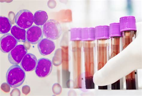 Nieuwe Behandeling Van Leukemie Vermindert Bijwerkingen Vib Ku Leuven