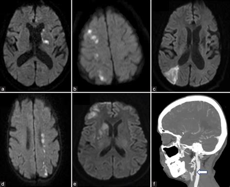 Clinical Characteristics And Imaging Patterns Of Cerebral Infarction