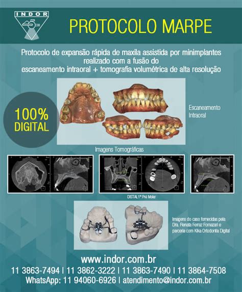 Protocolo Marpe A Técnica Conhecida Como Marpe Micro Implante Assisted