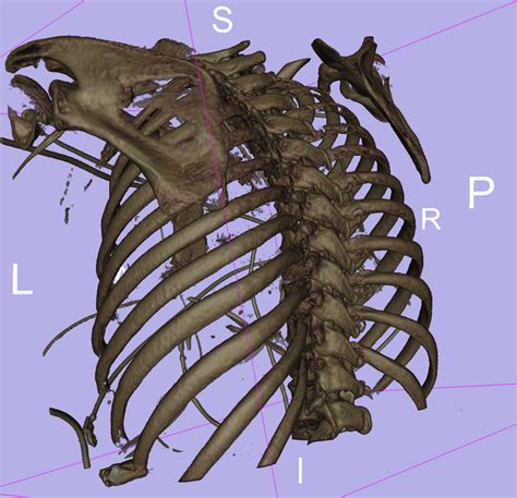 Challenge Segment A Spine NAMIC Wiki