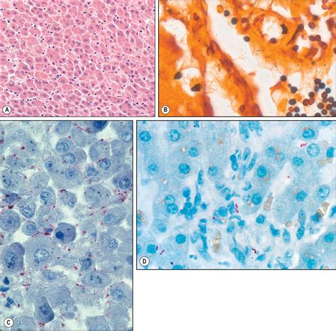 Non Hepatotropic Viral Bacterial And Parasitic Infections Of The Liver