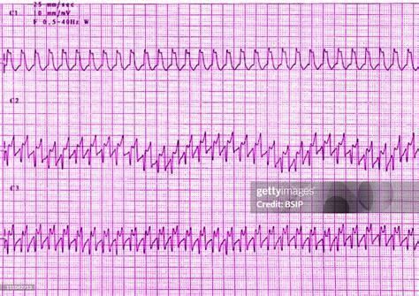 Ventricular Flutter Ecg Medicalce On X Ecg Of Af Atrial Flutter Vf