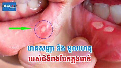 រោគសញ្ញា និង មូលហេតុ របស់ ជំងឺ ពងបែក ក្នុង មាត់