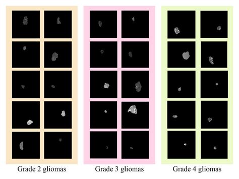 Extracted Tumor Areas As Input Images To The Deep Convolutional Neural Download Scientific